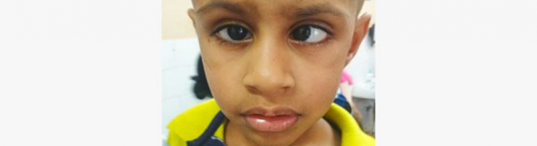 Squint Eye Correction Surgery at Goa | Persistent Foundation